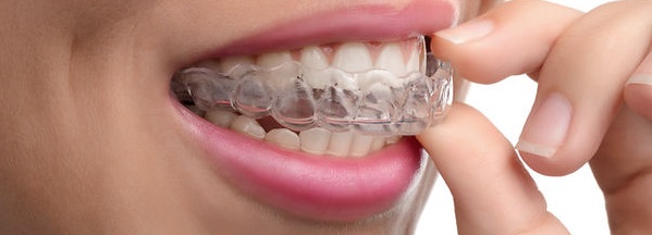 Invisalign: Unsichtbare Schienen für gerade Zähne